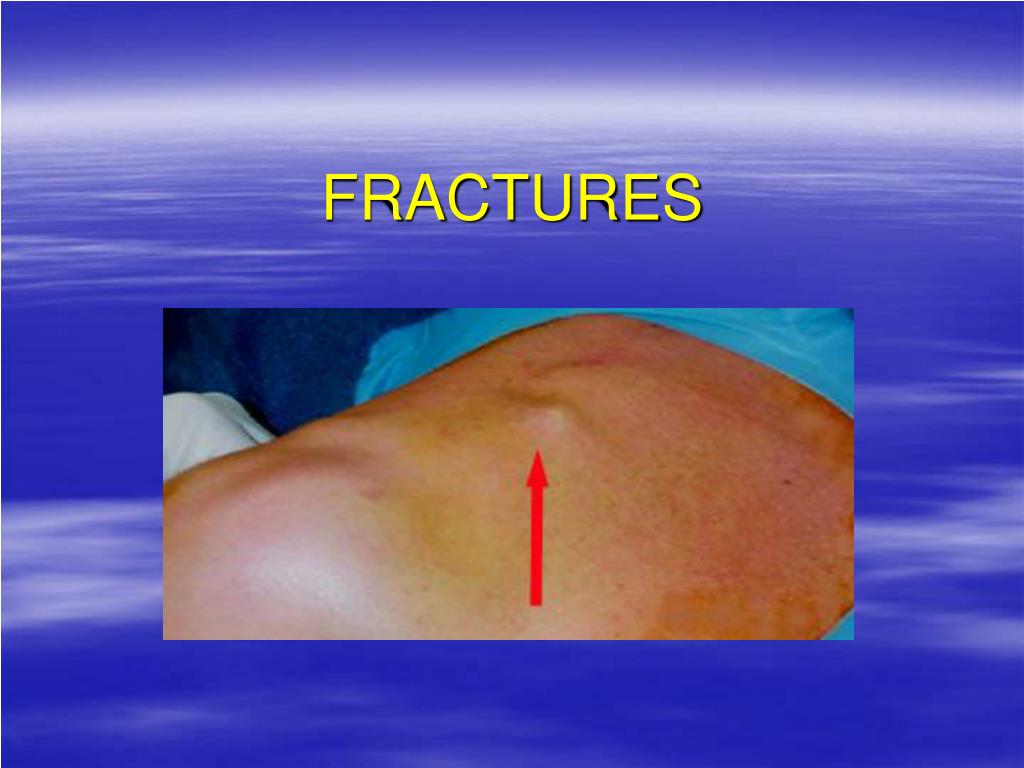 PPT - Nursing Care of Clients With Musculoskeletal Disorders PowerPoint ...