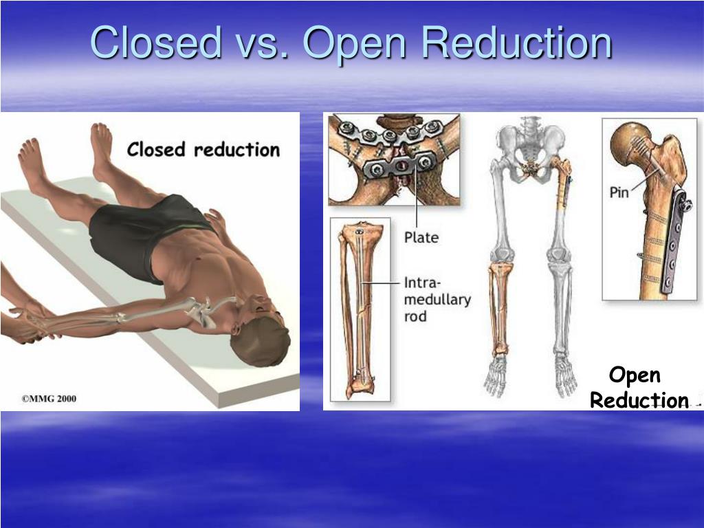 PPT - Nursing Care of Clients With Musculoskeletal Disorders PowerPoint ...