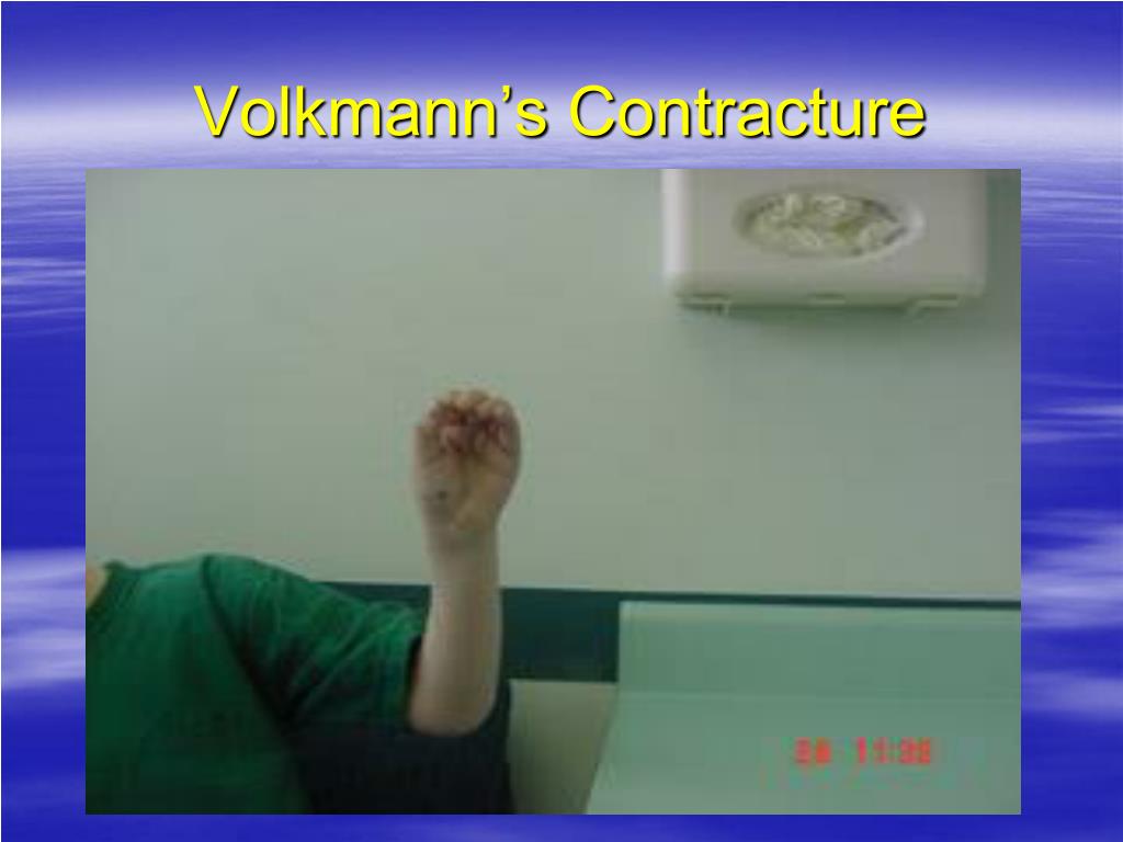 PPT - Nursing Care of Clients With Musculoskeletal Disorders PowerPoint ...