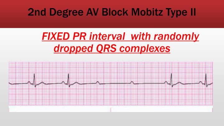 PPT - EKG PowerPoint Presentation - ID:3835591