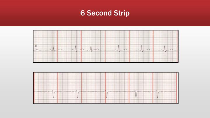 PPT - EKG PowerPoint Presentation - ID:3835591