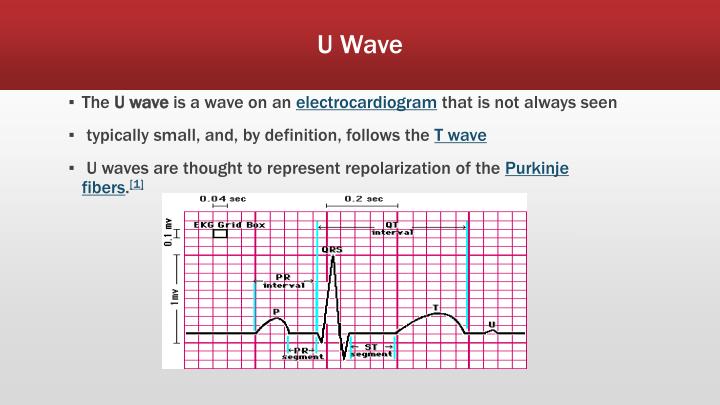 PPT - EKG PowerPoint Presentation - ID:3835591