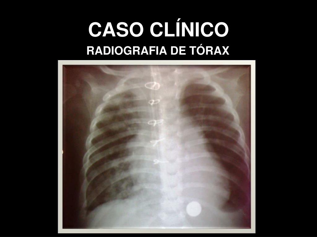 PPT - CASO CLÍNICO Defeito do septo atrioventricular total PowerPoint ... PPT - CASO CLÍNICO Defeito do septo atrioventricular total PowerPoint ...
