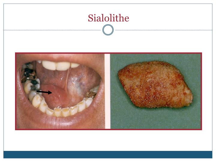 PPT - Maladies des glandes salivaires PowerPoint Presentation - ID:3837983