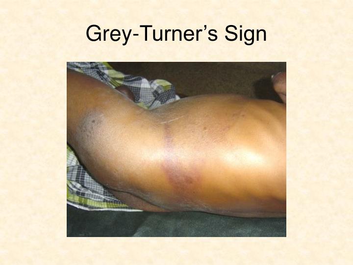 Ppt Acute Pancreatitis Powerpoint Presentation Id 3839247