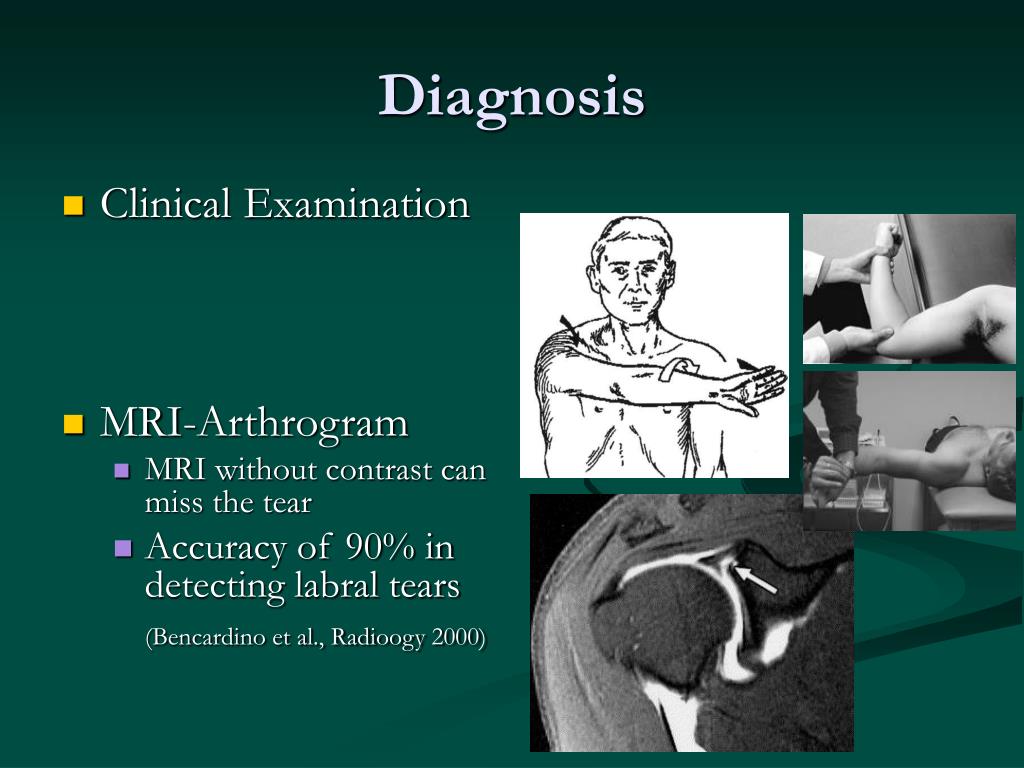 PPT - Superior Labral Anterior to Posterior (SLAP) Tears PowerPoint ...
