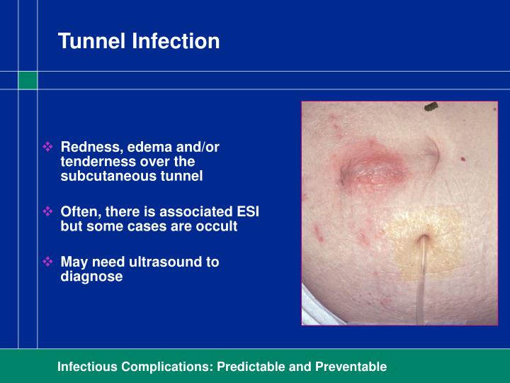 PPT - Infections in PD Prevention and Management PowerPoint ...
