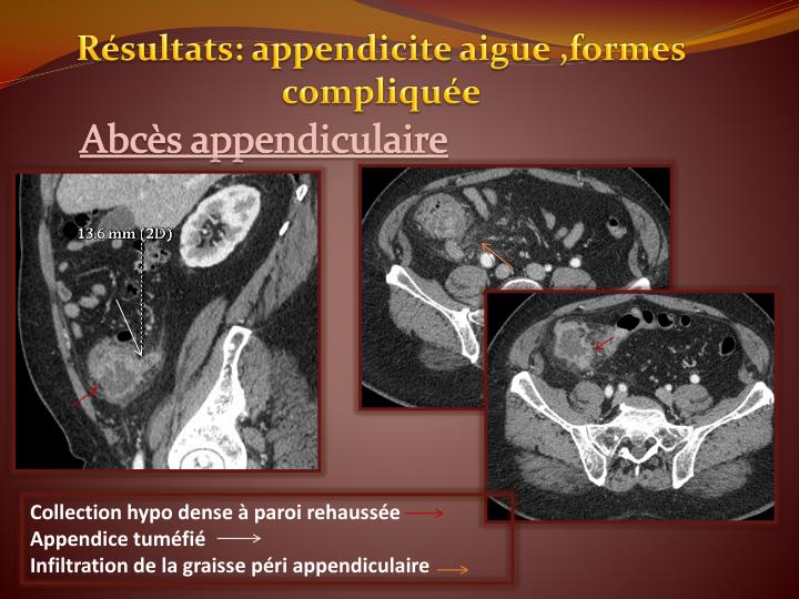 PPT - APPENDICITE AIGUE: PowerPoint Presentation - ID:3847352