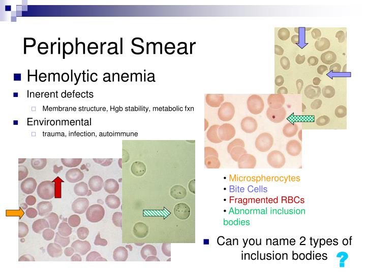 PPT - ANEMIA PowerPoint Presentation - ID:3848210