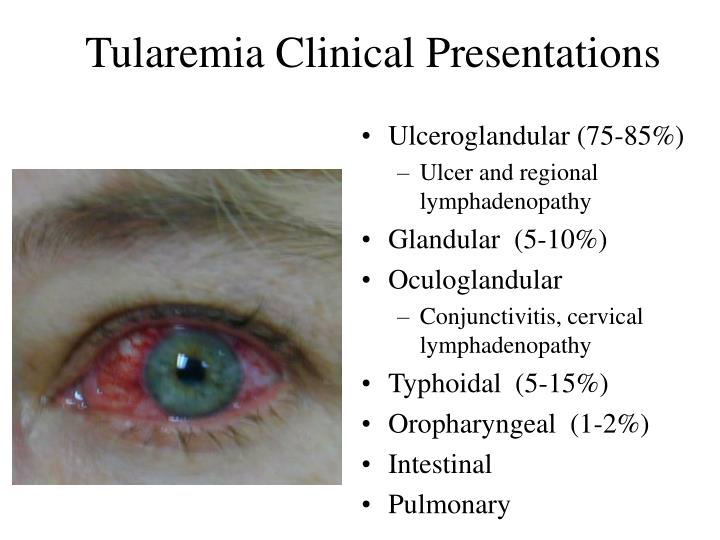 PPT - Plague & Tularemia PowerPoint Presentation - ID:3859187