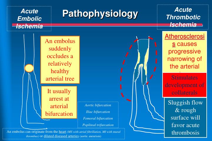 PPT - Peripheral Arterial Disease (PAD) PowerPoint Presentation - ID ...