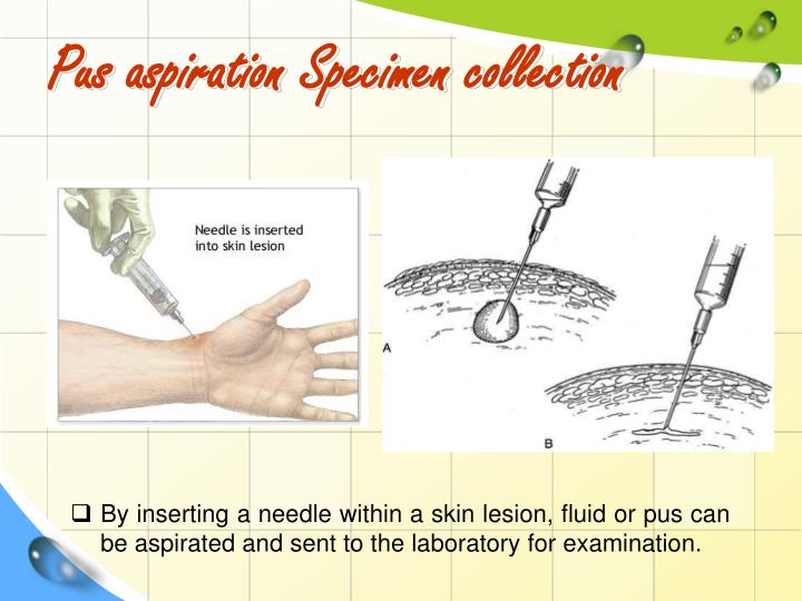 PPT - Pus (Abscesses, and sinuses) wound, and Burn Cultures PowerPoint ...