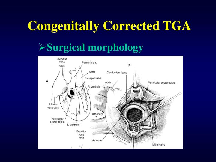 PPT - Corrected Transposition of Great Arteries PowerPoint Presentation ...