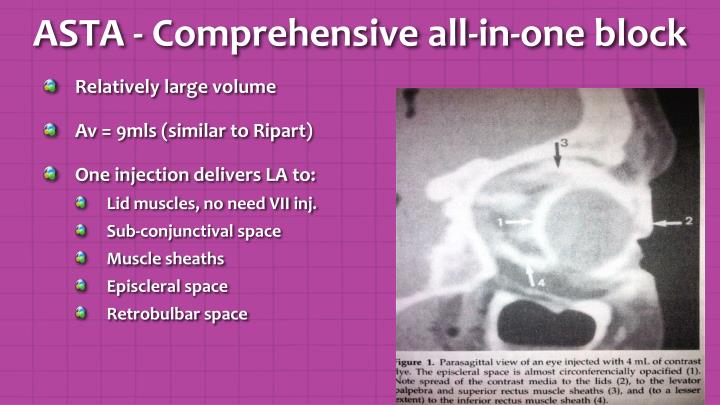PPT - Anterior Sub- Tenon’s Anaesthesia (ASTA) for Cataract Surgery ...