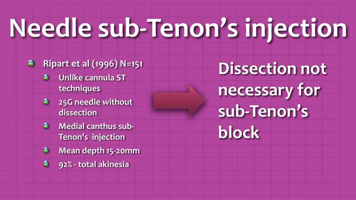 PPT - Anterior Sub- Tenon’s Anaesthesia (ASTA) for Cataract Surgery ...