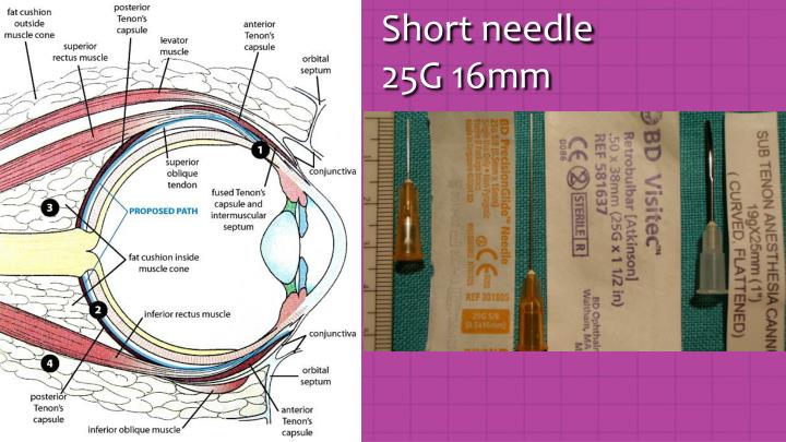 PPT - Anterior Sub- Tenon’s Anaesthesia (ASTA) for Cataract Surgery ...