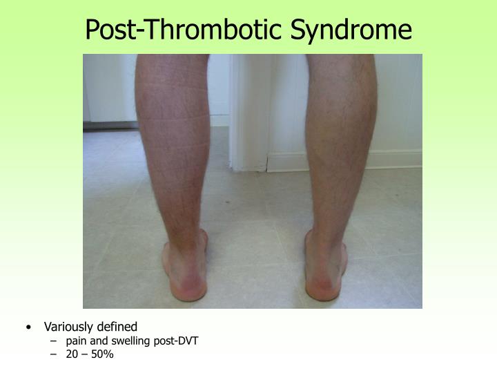 PPT - Venothrombotic Disease & Urological Surgery PowerPoint ...