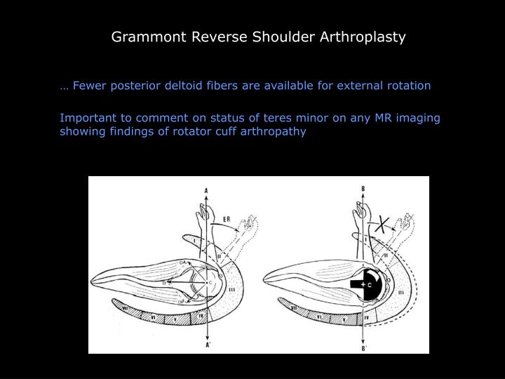 PPT - -- First shoulder arthroplasty PowerPoint Presentation - ID:3886401