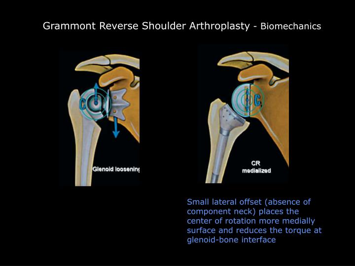 PPT - -- First shoulder arthroplasty PowerPoint Presentation - ID:3886401