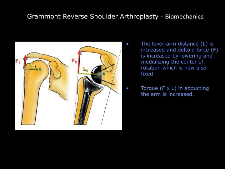 PPT - -- First shoulder arthroplasty PowerPoint Presentation - ID:3886401