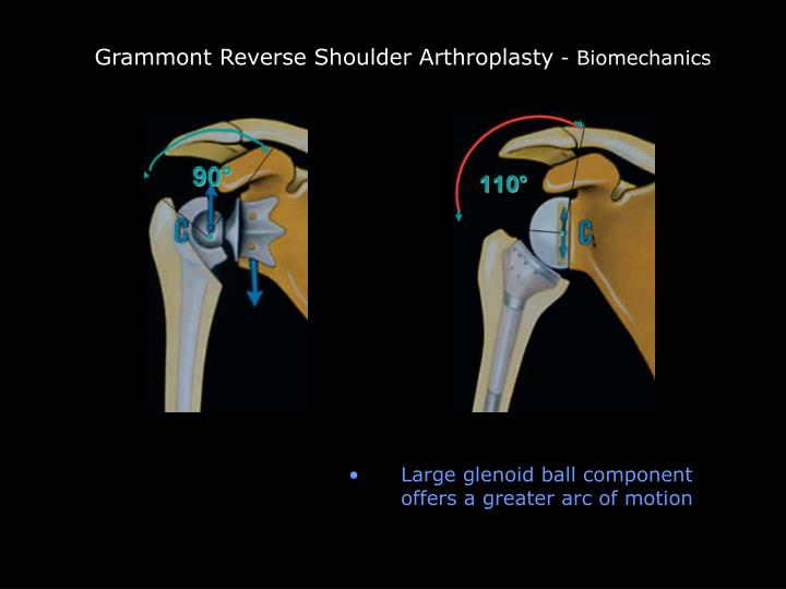 PPT - -- First shoulder arthroplasty PowerPoint Presentation - ID:3886401