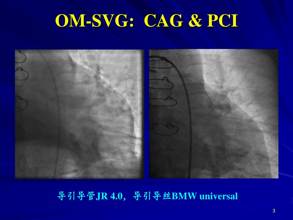 PPT - CABG 术后再次血运重建 PowerPoint Presentation, free download - ID:3887095