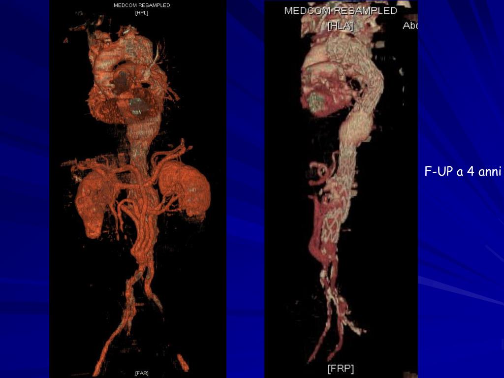 PPT - Il trattamento ibrido degli aneurismi toraco-addominali ...