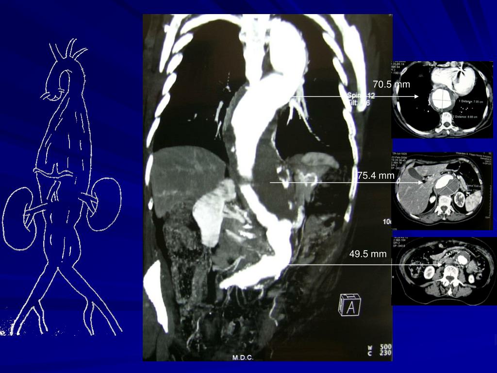 PPT - Il trattamento ibrido degli aneurismi toraco-addominali ...