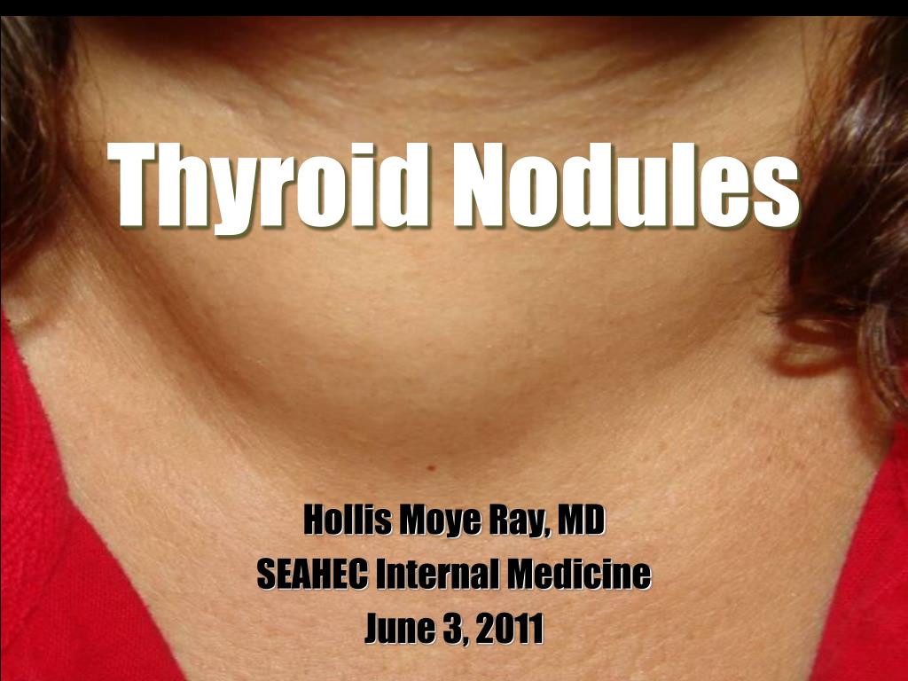 Ppt Thyroid Nodules Powerpoint Presentation Free Download Id 3907884