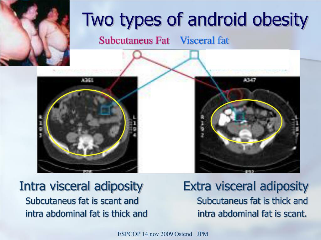 PPT - Pathophysiology of obesitas, impact on laparoscopy J P Mulier MD ...