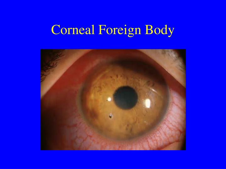 PPT - Ocular Trauma PowerPoint Presentation - ID:3917049