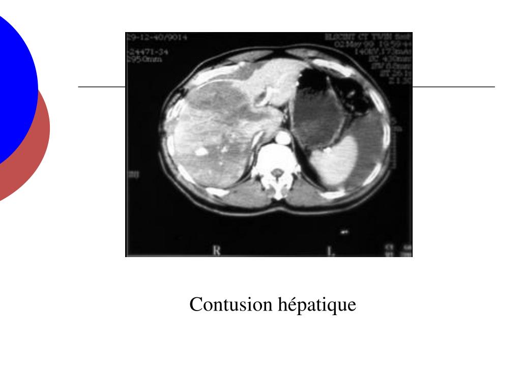 PPT - INTRODUCTION: Le traumatisme de l’abdomen chez l’enfant est très ...
