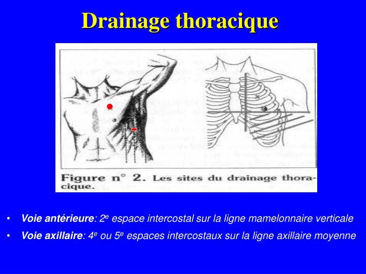PPT - Plaies pénétrantes thoraco-abdominales de l’adulte PowerPoint ...