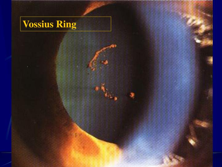 PPT - Cataract PowerPoint Presentation - ID:3930717