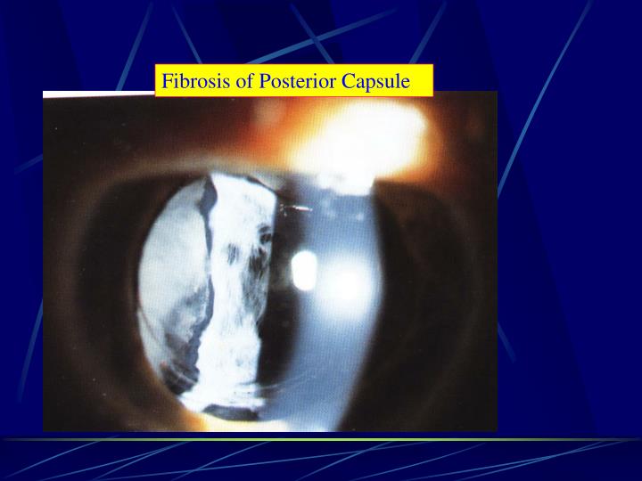 PPT - Cataract PowerPoint Presentation - ID:3930717