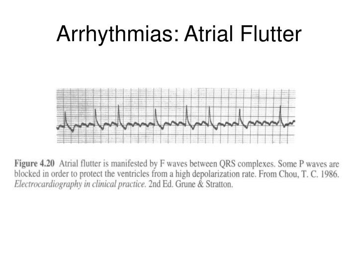 PPT - Lecture 7 Chapter 13: Therapeutic/Prosthetic Devices – Pacemakers ...