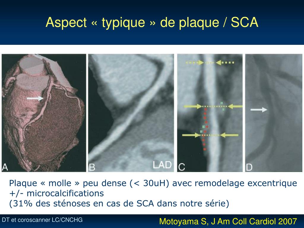PPT - Douleur thoracique aiguë. Place du CoroScanner. PowerPoint ...