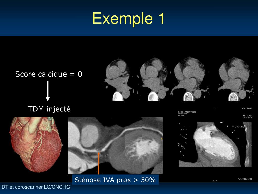 PPT - Douleur thoracique aiguë. Place du CoroScanner. PowerPoint ...