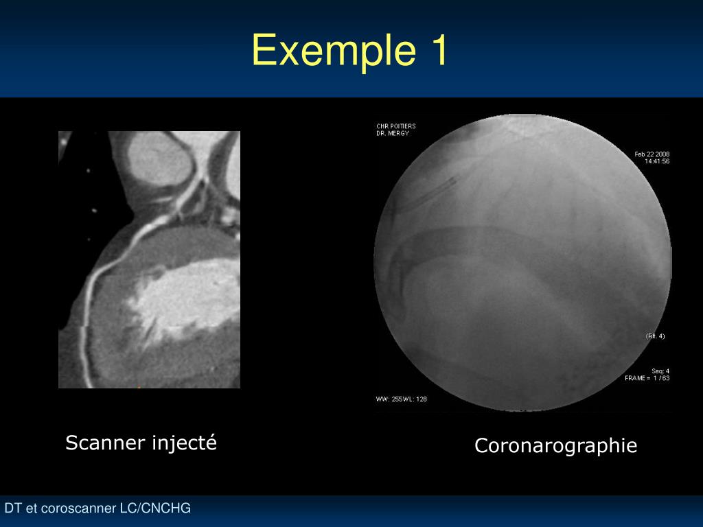 PPT - Douleur thoracique aiguë. Place du CoroScanner. PowerPoint ...