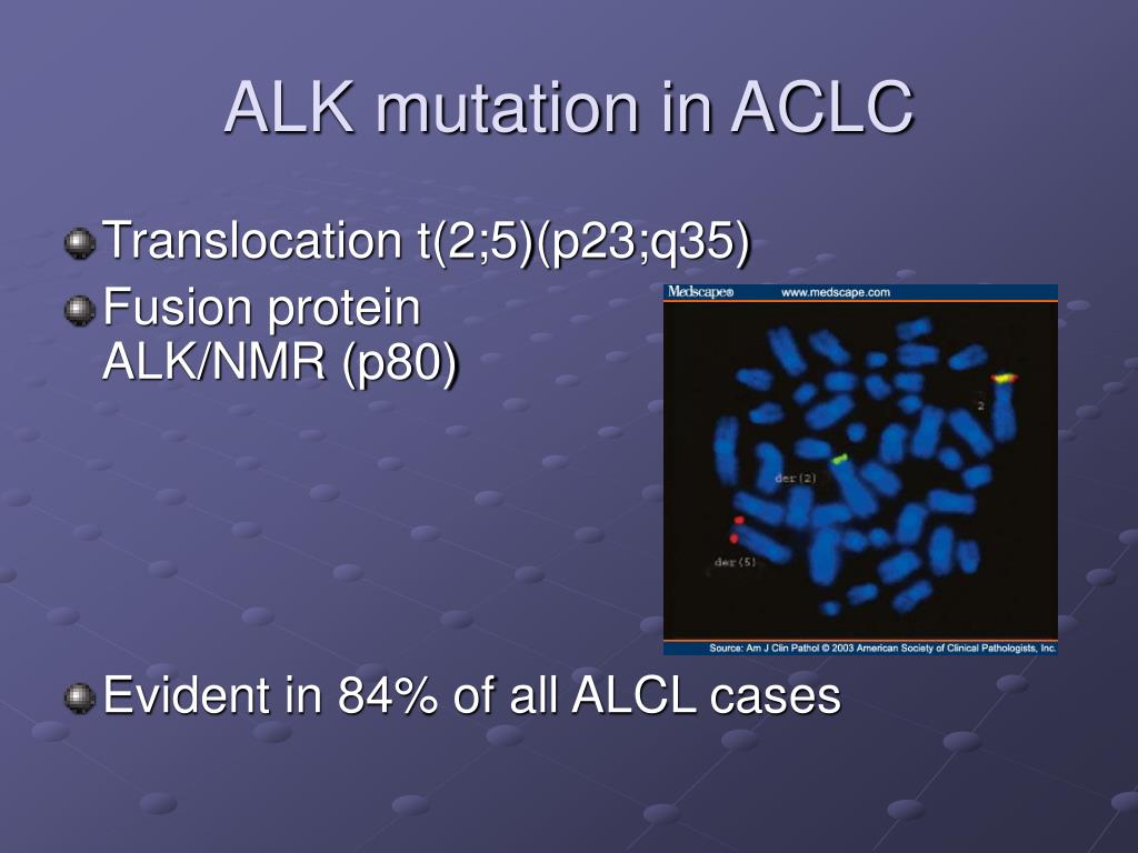 PPT - The Role of Alk in Anaplastic Large-cell Lymphoma (ALCL ...