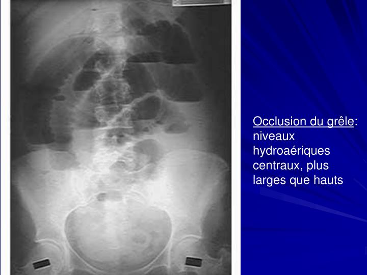 PPT - OCCLUSIONS PowerPoint Presentation - ID:3944876