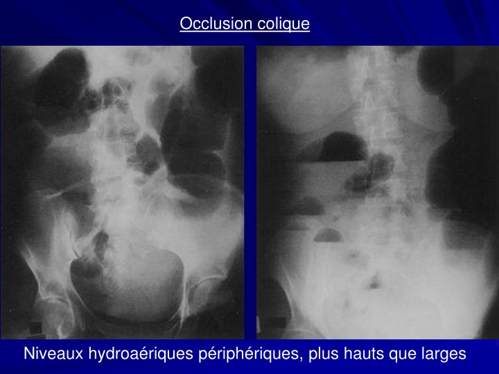 PPT - OCCLUSIONS PowerPoint Presentation - ID:3944876
