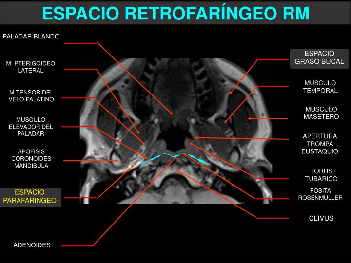 PPT - ESPACIO RETROFARINGEO PowerPoint Presentation - ID:3948035