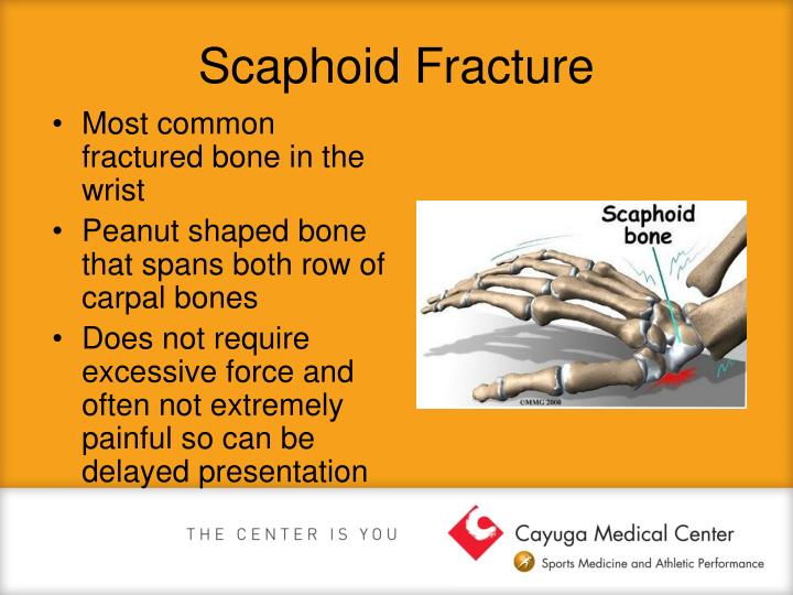 PPT - Common Hand and Wrist Injuries PowerPoint Presentation - ID:3950482