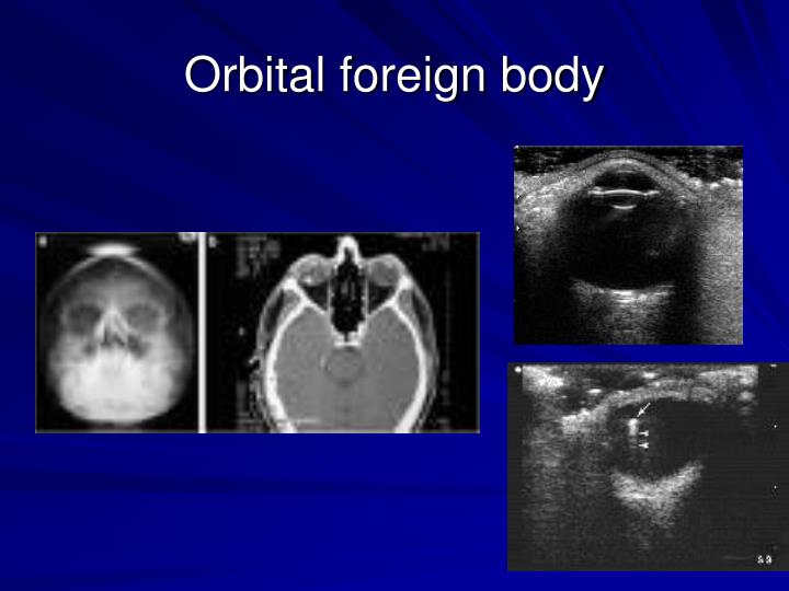 PPT - Ophthalmologic Emergencies PowerPoint Presentation - ID:3951268