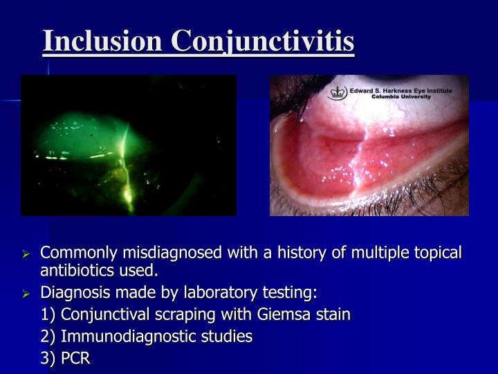 Inclusion Conjunctivitis Bacterial Conjunctivitis