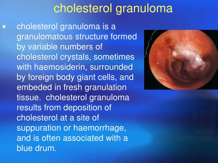 PPT - OTITIS MEDIA PowerPoint Presentation - ID:3956264