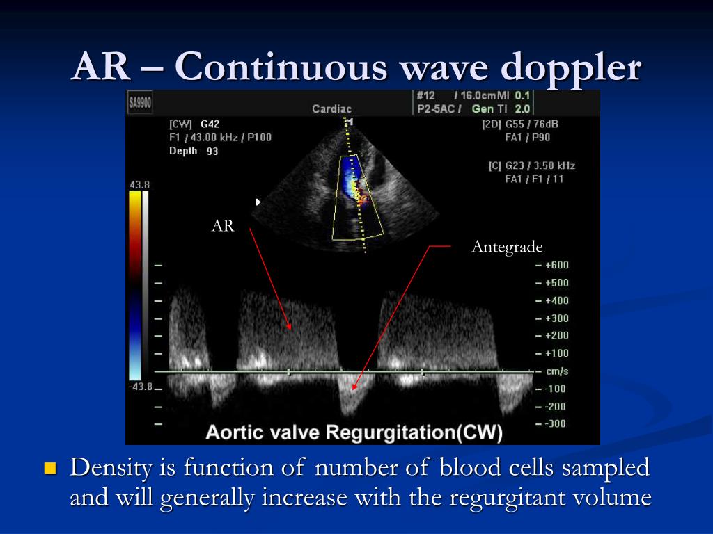 PPT - Echo Conference Aortic Regurgitation PowerPoint Presentation ... PPT - Echo Conference Aortic Regurgitation PowerPoint Presentation ...