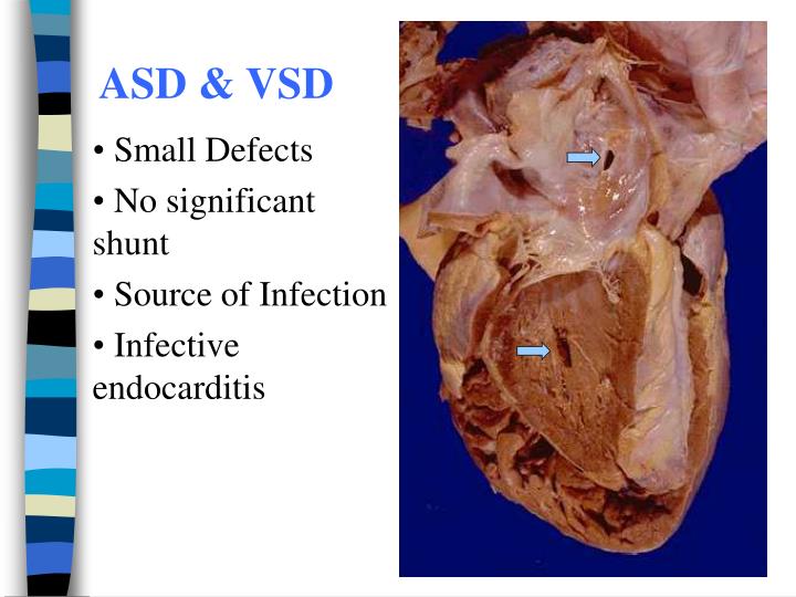 PPT - Congenital Heart Diseases PowerPoint Presentation - ID:3964208