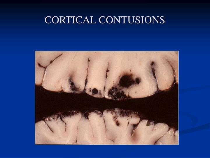 PPT - Traumatic Brain Injury PowerPoint Presentation - ID:3964316